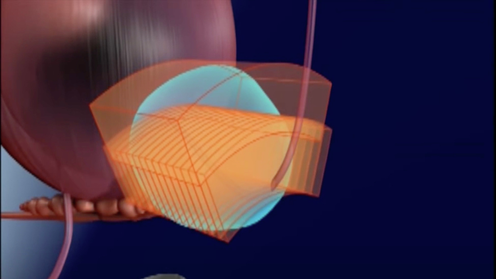 High-intensity focused ultrasound for prostate cancer | Penn Medicine