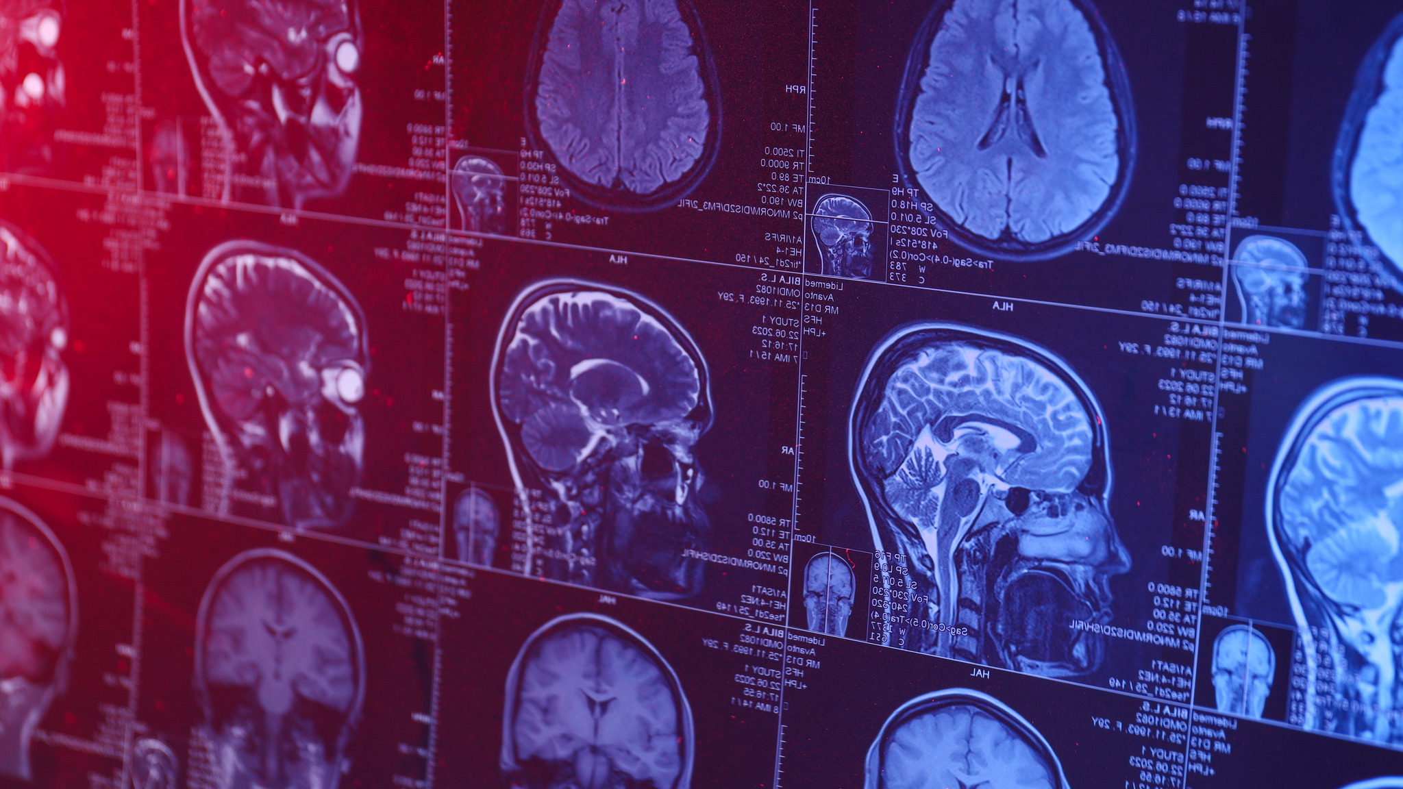 Cerebral Amyloid Angiopathy – Symptoms and Causes| Penn Medicine